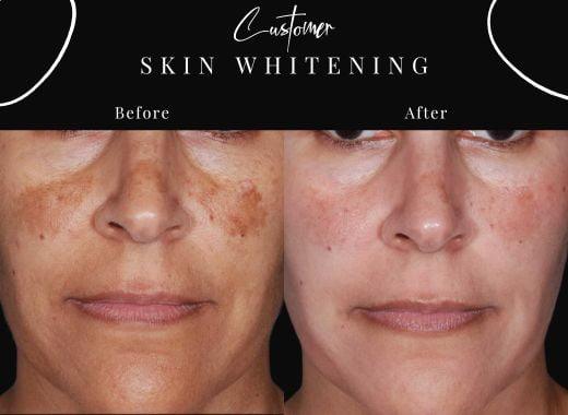 Skin Whitening Treatment in Islamabad Pakistan - ERCs