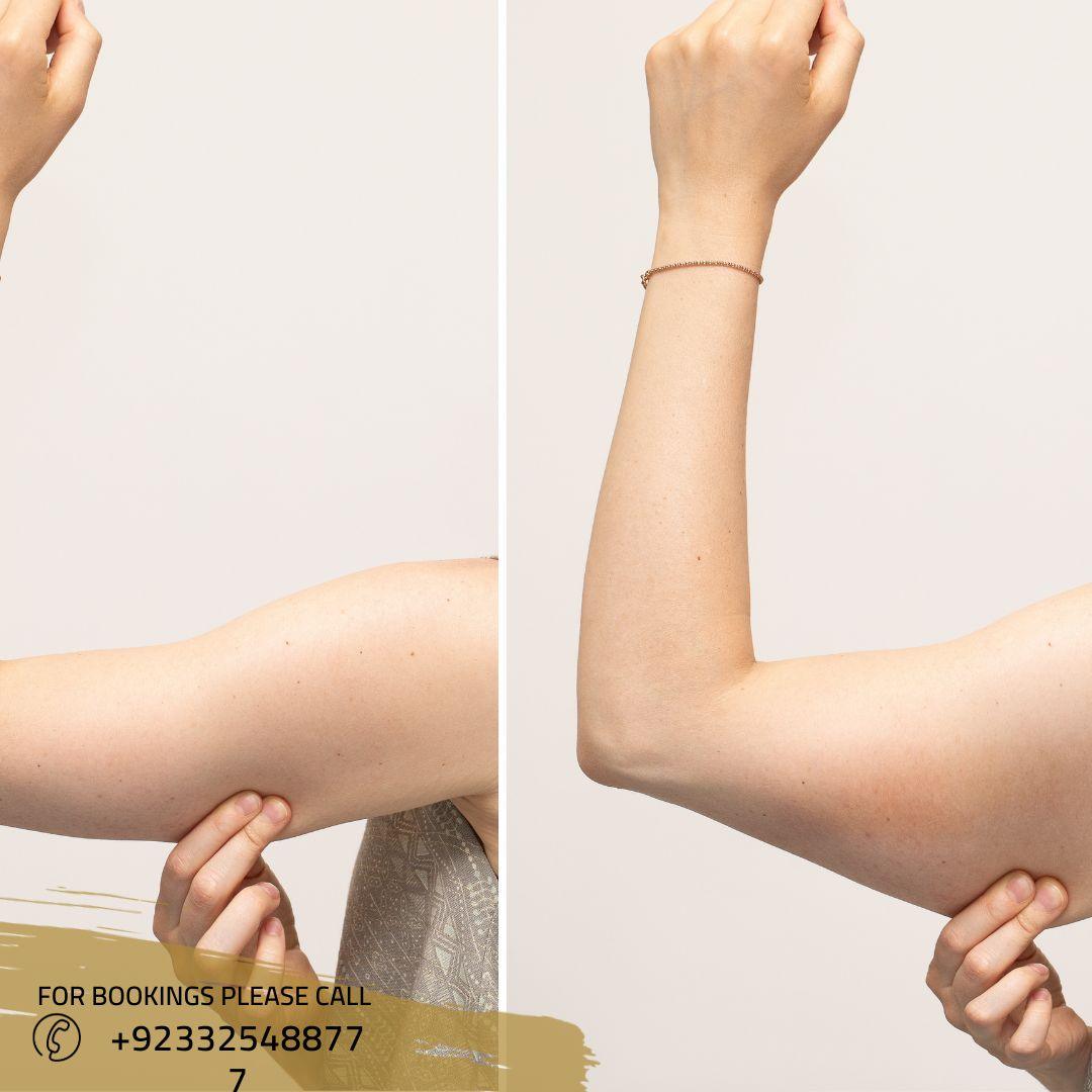 Arm lift in Islamabad Pakistan - ERCs