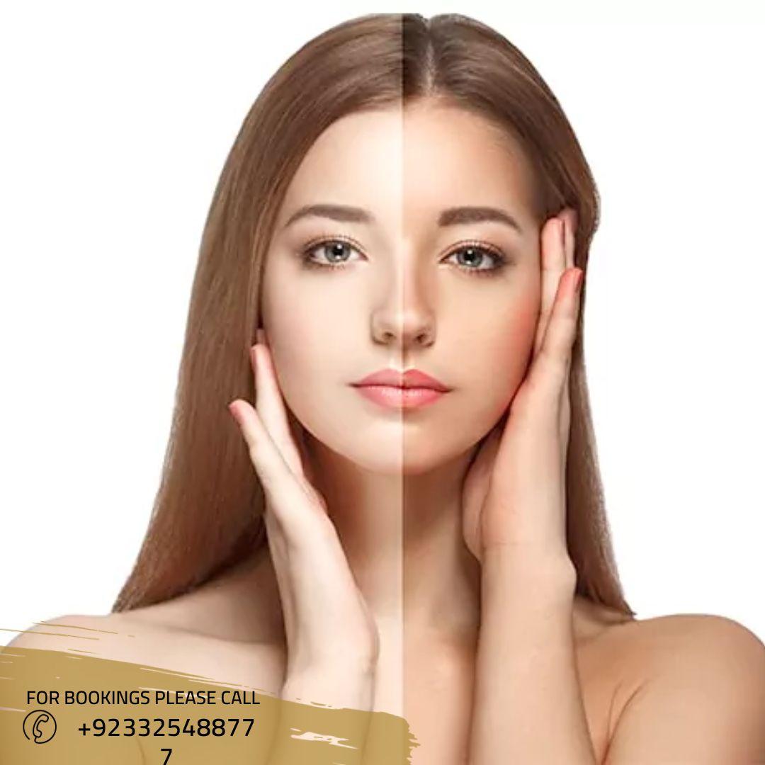 Skin Whitening Treatment in Islamabad Pakistan - ERCs