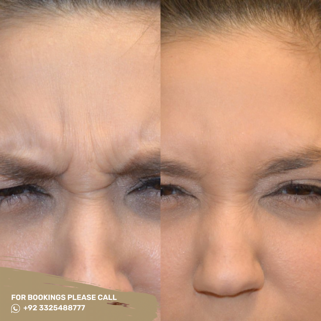 Botox injections in Islamabad,Pakistan | ERCs