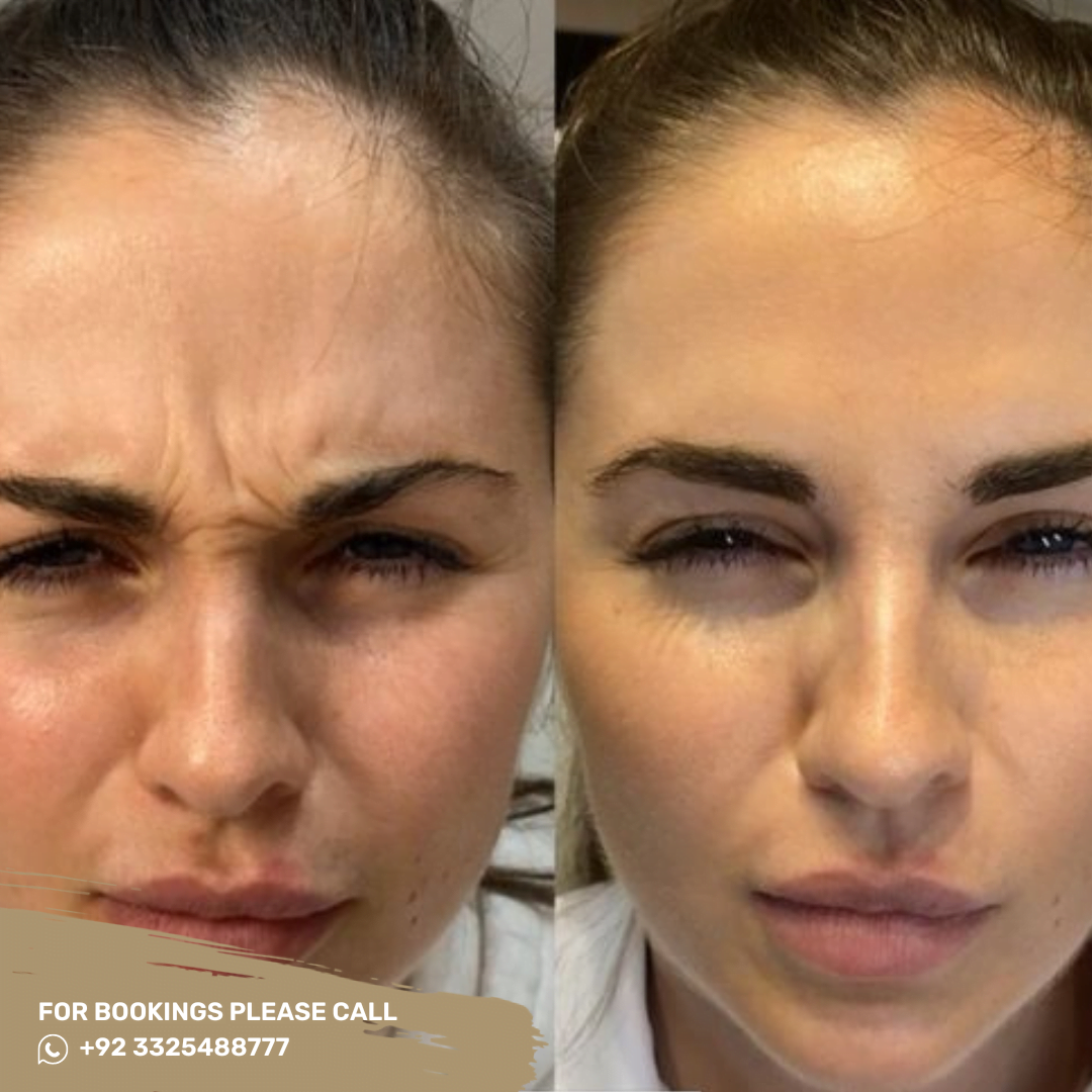 Botox injections in Islamabad,Pakistan | ERCs