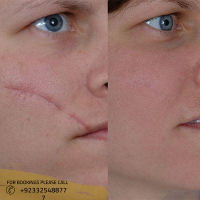 Surgical Scar Revision in Islamabad – Best Scar Removal Surgery