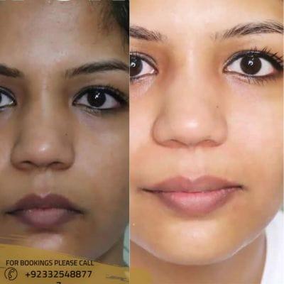 Smoker’s Lips Treatment in Islamabad