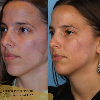 Surgical Scar Revision in Islamabad – Best Scar Removal Surgery