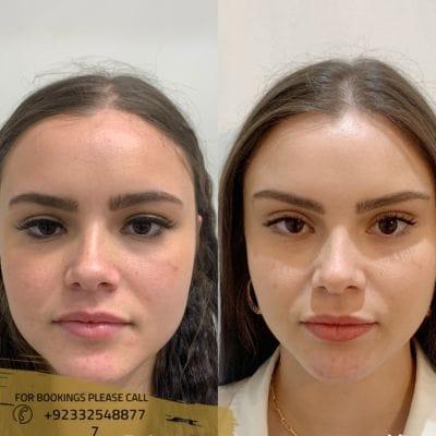 Thread lift Treatment in Islamabad, Pakistan