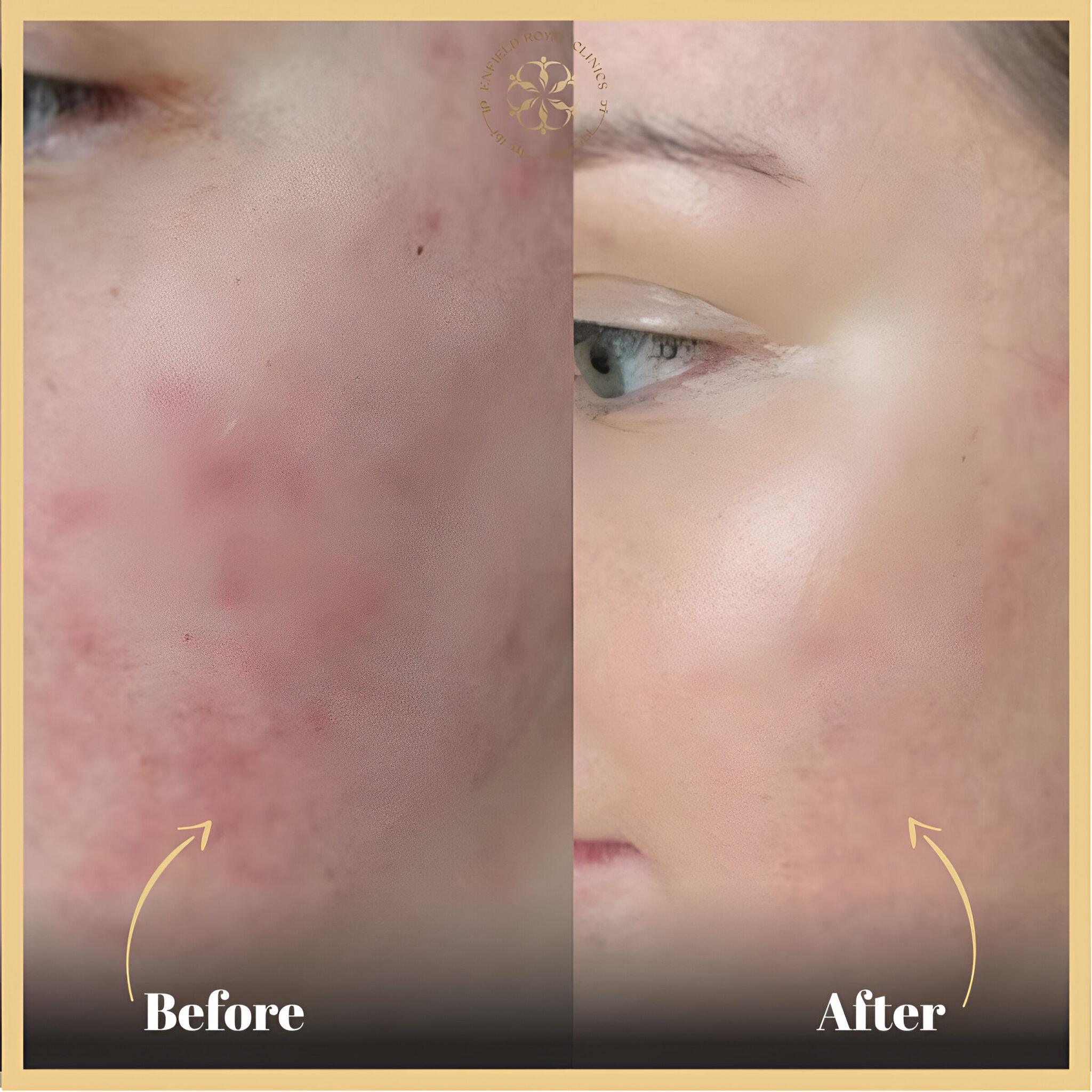 Red Carpet Facial treatment in Islamabad - F7