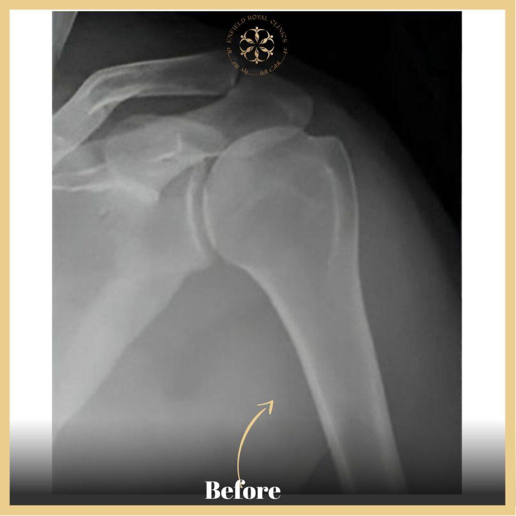 Shoulder Arthroplasties Treatment in Islamabad