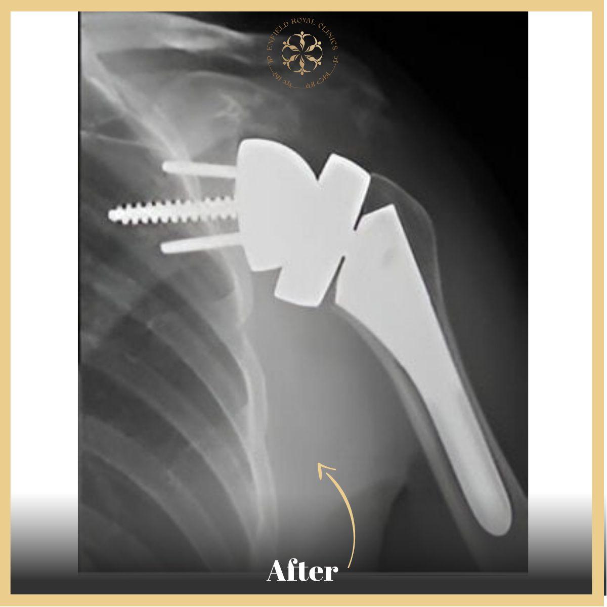 Shoulder Arthroplasties Treatment in Islamabad