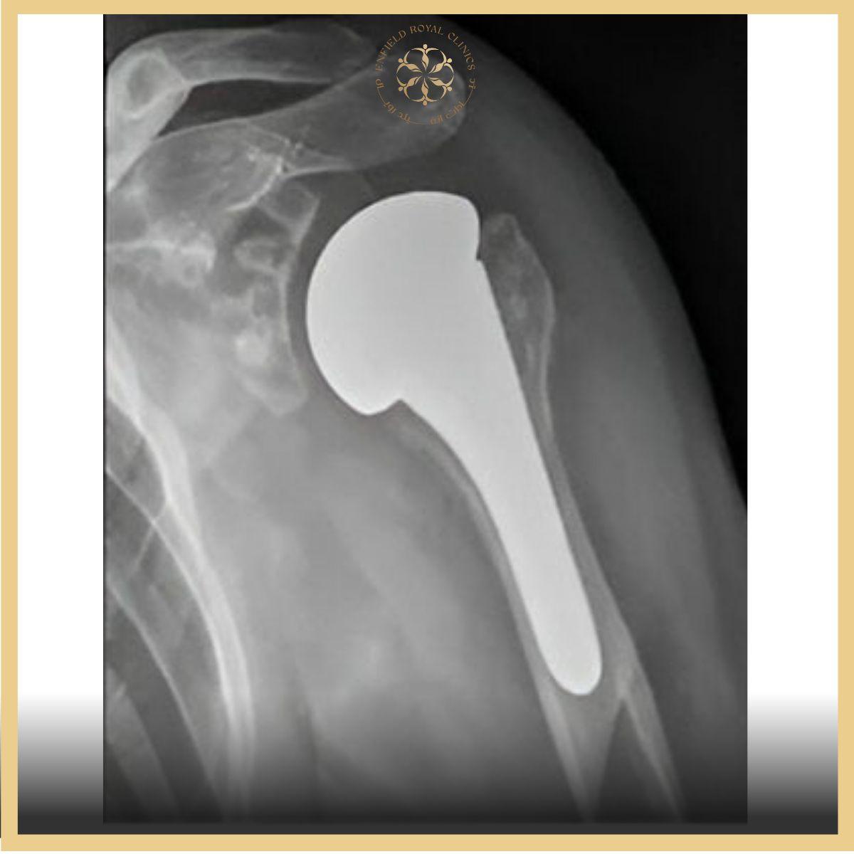 Shoulder Arthroplasties Treatment in Islamabad
