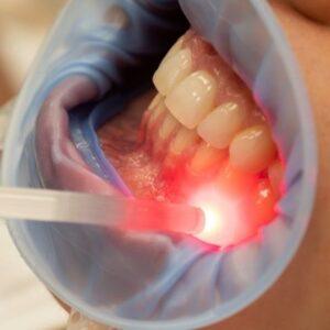 Gum Depigmentation Cost and Procedure Insights