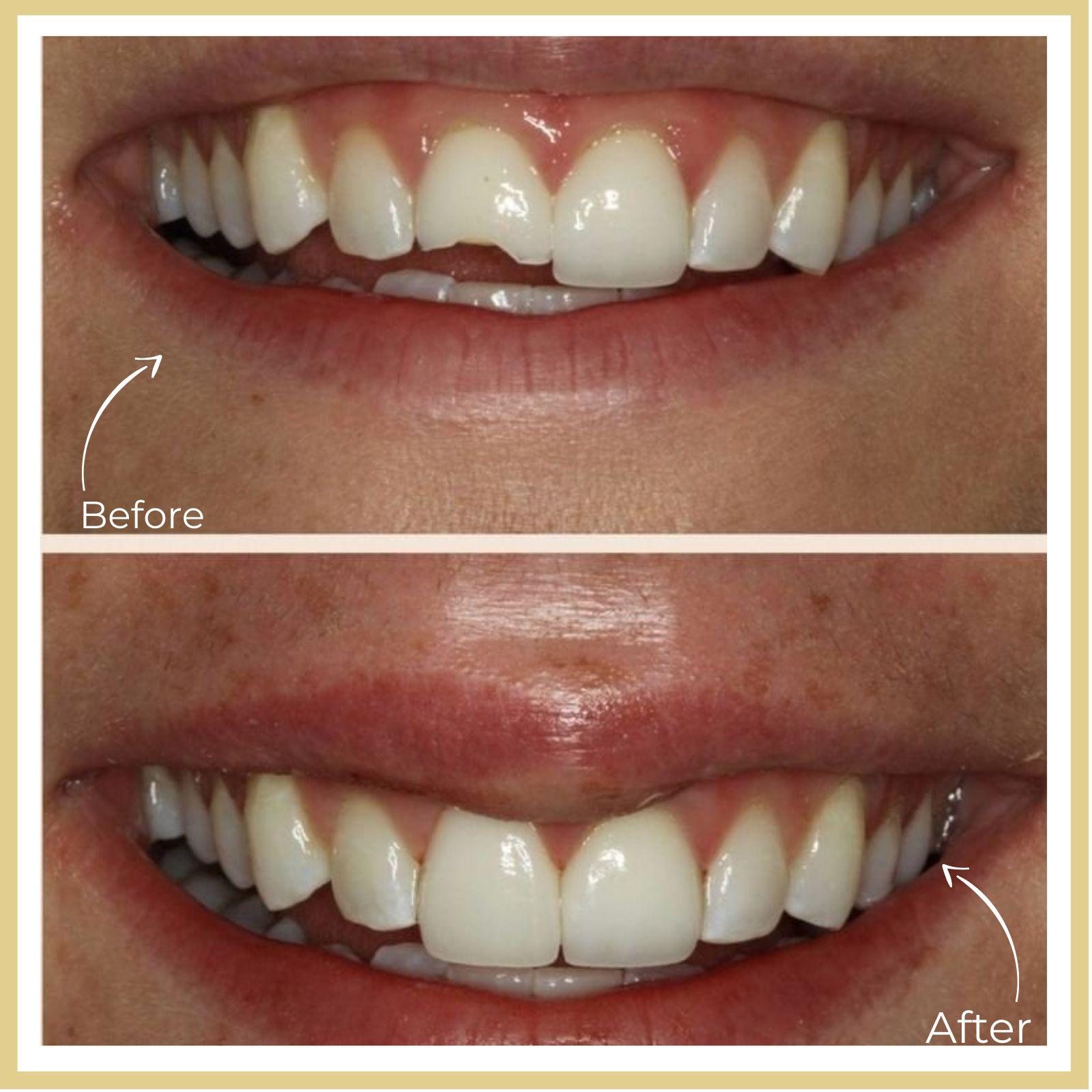 Fractured Teeth Treatment in Islamabad