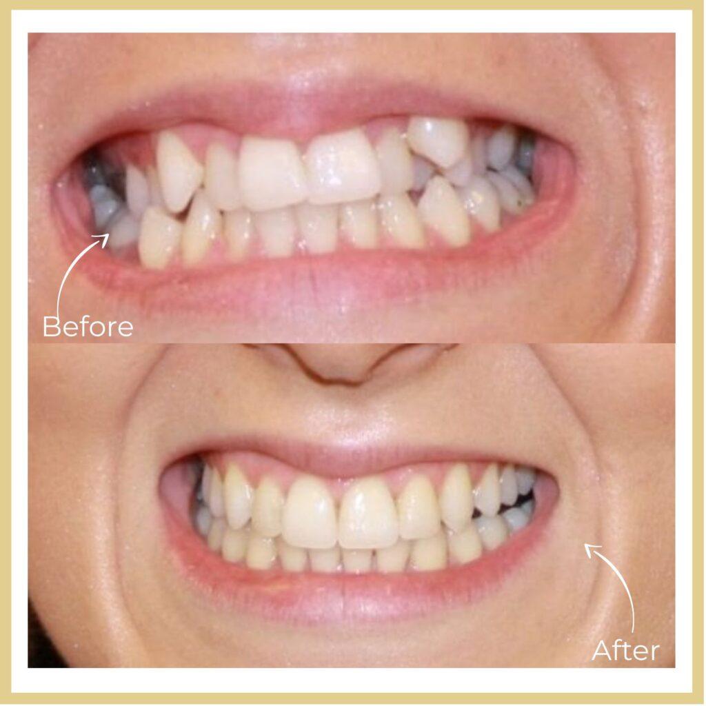 Overlapping Teeth Treatment in Islamabad