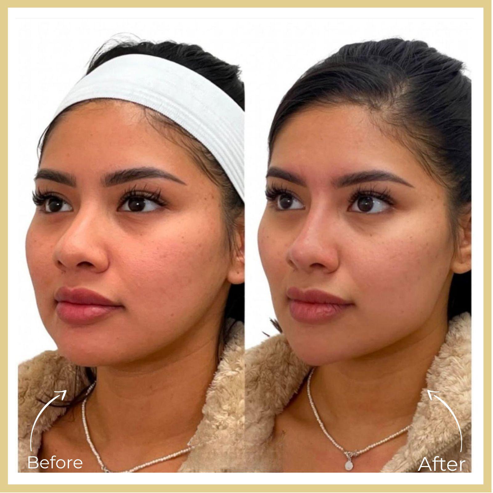 Jawline Contouring in Islamabad - Jawline Filler